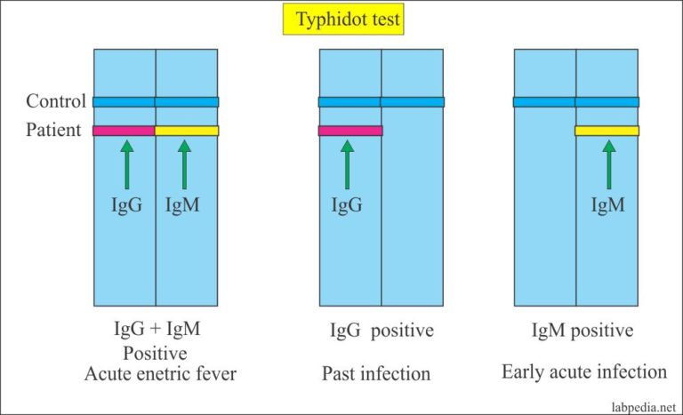 Typhoid Fever, Enteric Fever (Salmonella typhi)