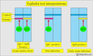 Enteric fever, widal test interpretations