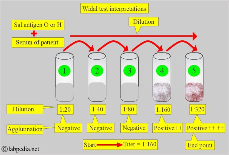 Enteric fever, widal test interpretations
