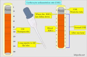Erythrocyte sedimentation rate (ESR) solution and procedure