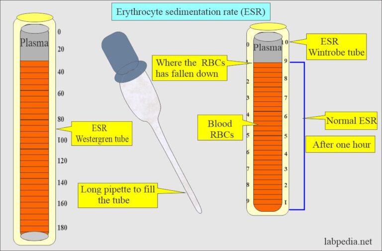 Erythrocyte sedimentation rate (ESR) solution and procedure