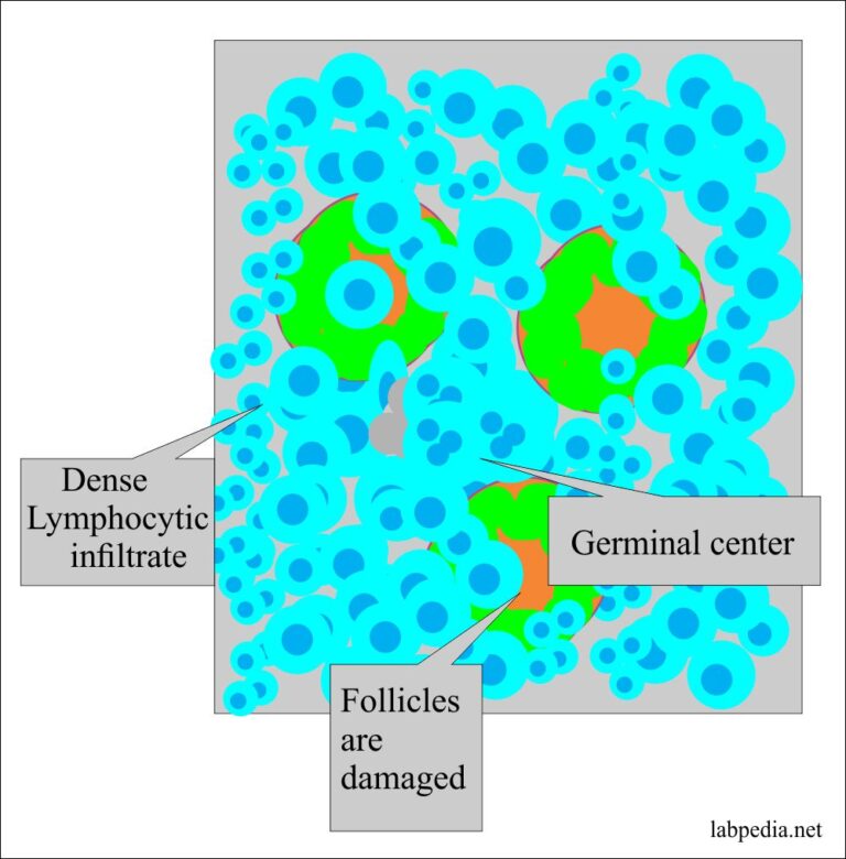 Chapter 23: Autoimmune diseases, Hashimoto's Thyroiditis and Grave's ...