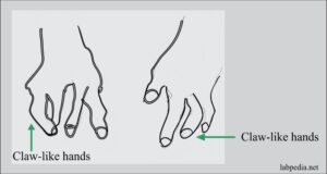Chapter 20: Autoimmune diseases, Progressive Systemic Sclerosis (PSS ...