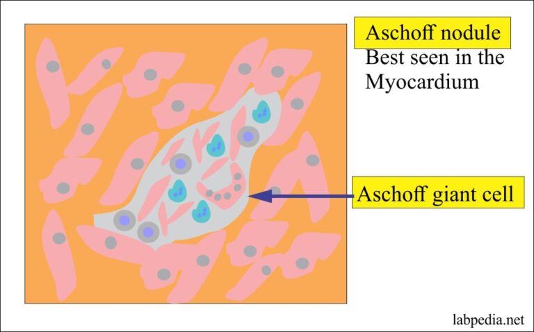 Chapter 25: Autoimmune diseases - Rheumatic Fever - Labpedia.net