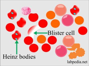 Anemia:- Part 10 - Glucose-6-Phosphate Dehydrogenase Deficiency Anemia ...
