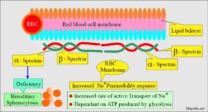 Anemia:- Part 7 - Hereditary Spherocytosis - Labpedia.net
