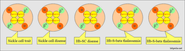 Anemia:- Part 5 A - Sickle Cell Anemia, Discussion and Workup ...