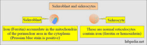 Anemia:- Part 9 - Sideroblastic Anemia, and Anemia Due To Chronic ...