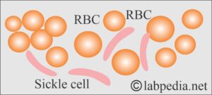 Anemia:- Part 5 A - Sickle Cell Anemia, Discussion and Workup ...